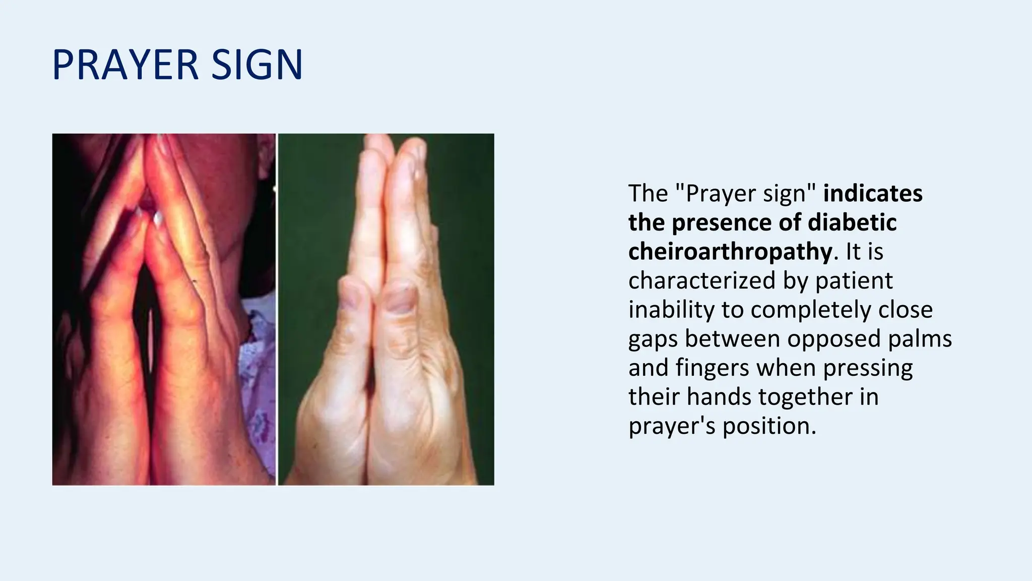Airway assessment and difficult airway anaesthesia | PPTX