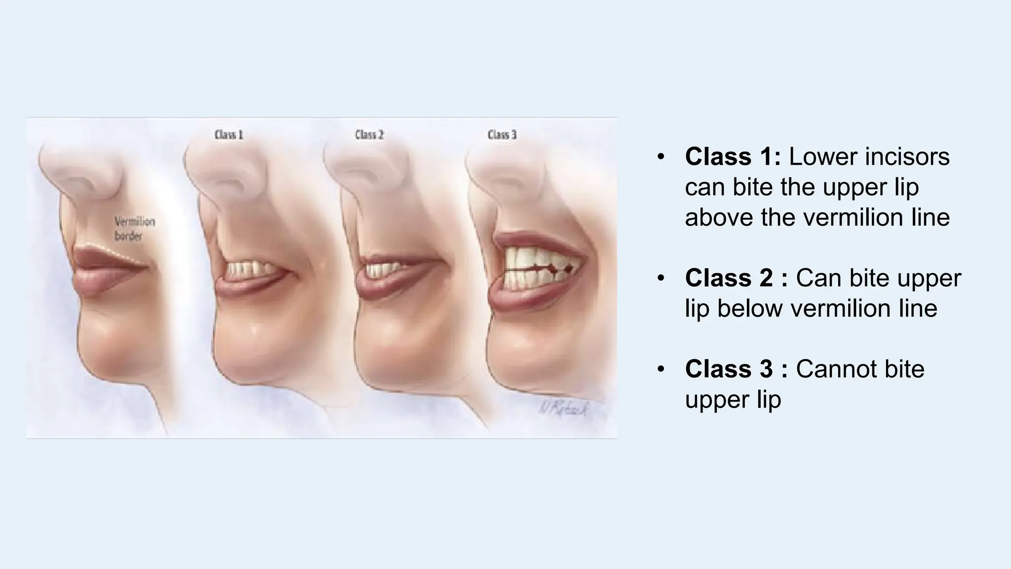 Airway assessment and difficult airway anaesthesia | PPTX