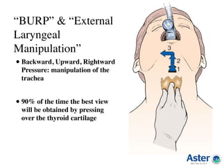 Difficult airway : Made easy | PPT
