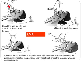 airway management recorded for S2.pptx