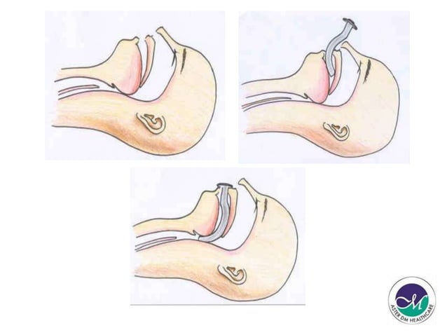 Airway solutions in trauma scenarios | PPTX