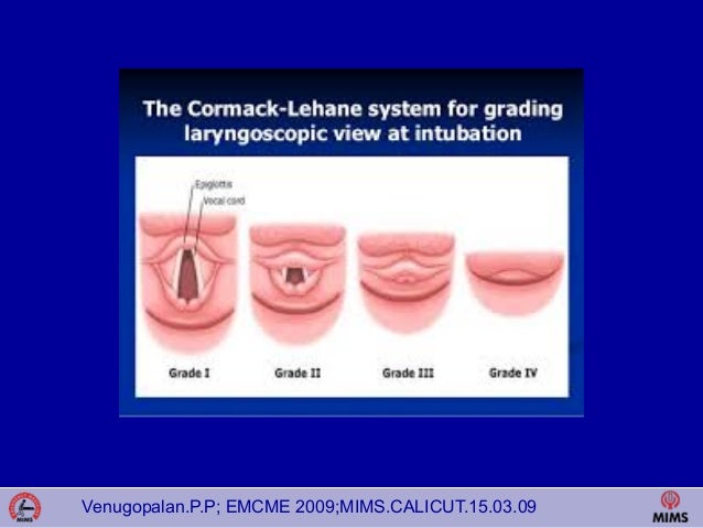 Airway management in ED - Basics and advanced
