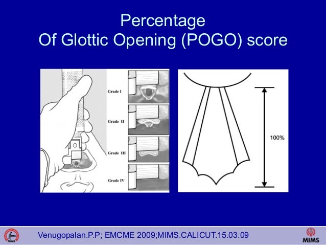 Airway management in ED - Basics and advanced