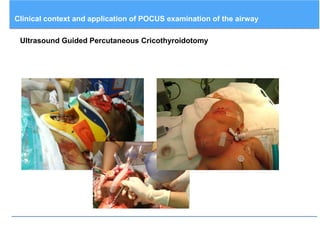 AIRWAY Ultrasound pocus assessment Malaysia | PDF