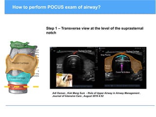 AIRWAY Ultrasound pocus assessment Malaysia | PDF