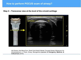 AIRWAY Ultrasound pocus assessment Malaysia | PDF