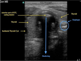 AIRWAY Ultrasound pocus ultrasound slide | PDF