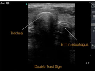 AIRWAY Ultrasound pocus ultrasound slide | PDF