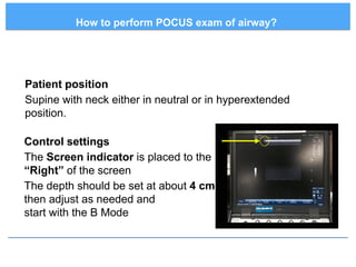 AIRWAY Ultrasound pocus ultrasound slide | PDF