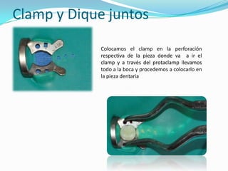 Aislamiento del campo operatorio en operatoria dental | PPTX