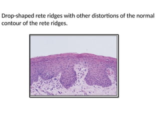 Leukoplakia, a pre malignant lesion and condition of epithelia tissue ...