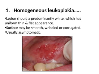 Leukoplakia, a pre malignant lesion and condition of epithelia tissue ...