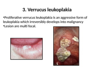 Leukoplakia, a pre malignant lesion and condition of epithelia tissue ...
