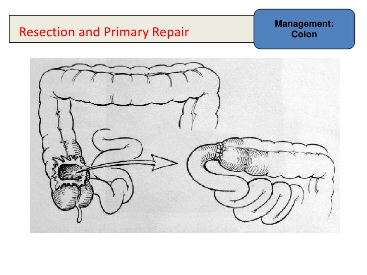 AJ. Bowel Injuries. 26 apr 2012