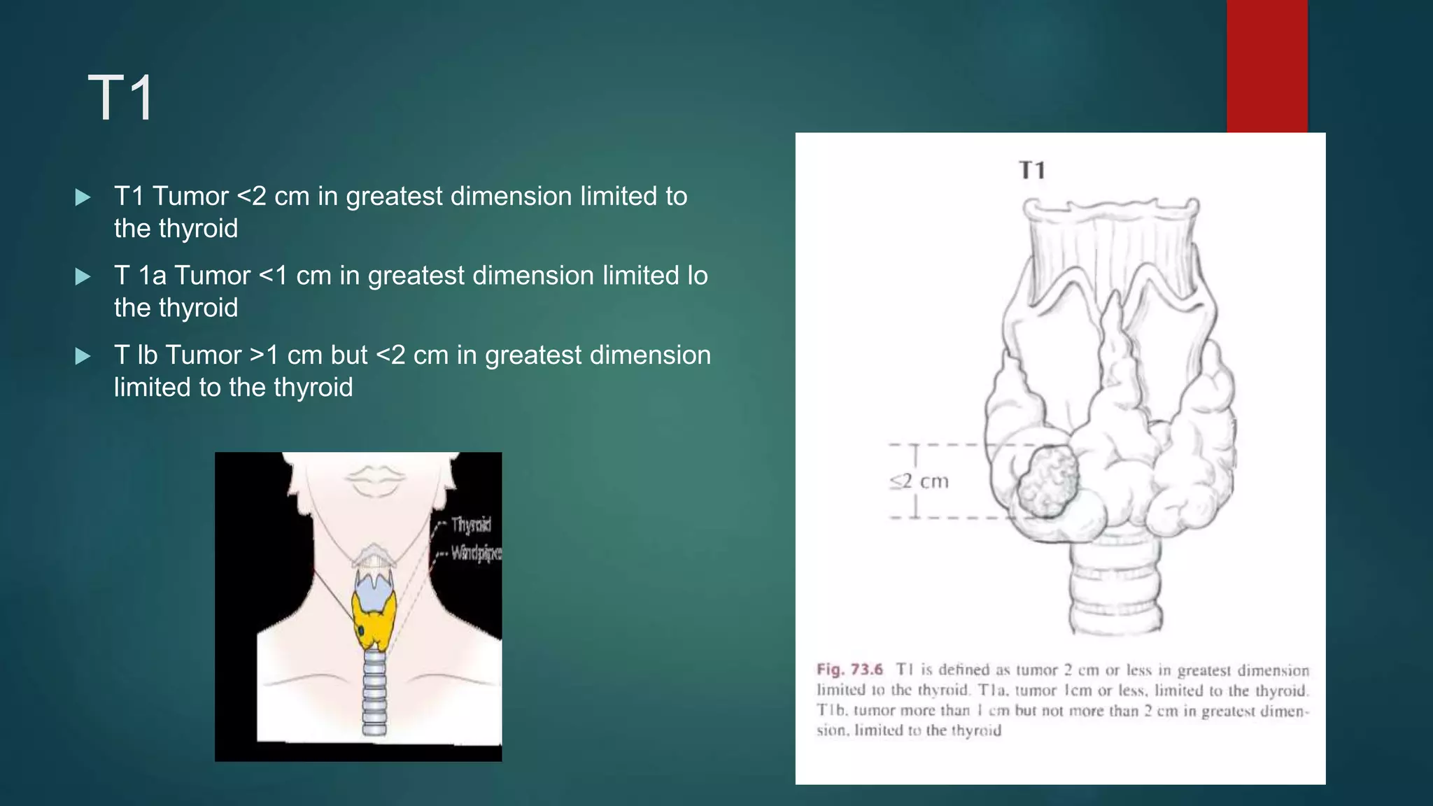 AJCC TNM staging of thyroid 8th edition ppt | PPTX
