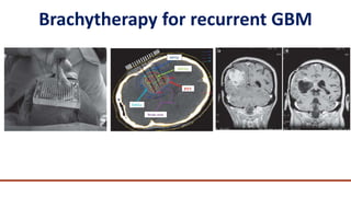 Management of recurrent Glioblastoma and role of Bevacizumab | PPTX
