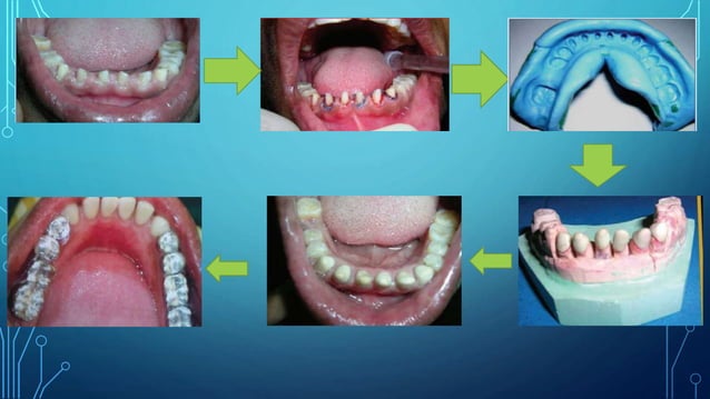impressions in fpd | PPTX | Dental Health | Diseases and Conditions