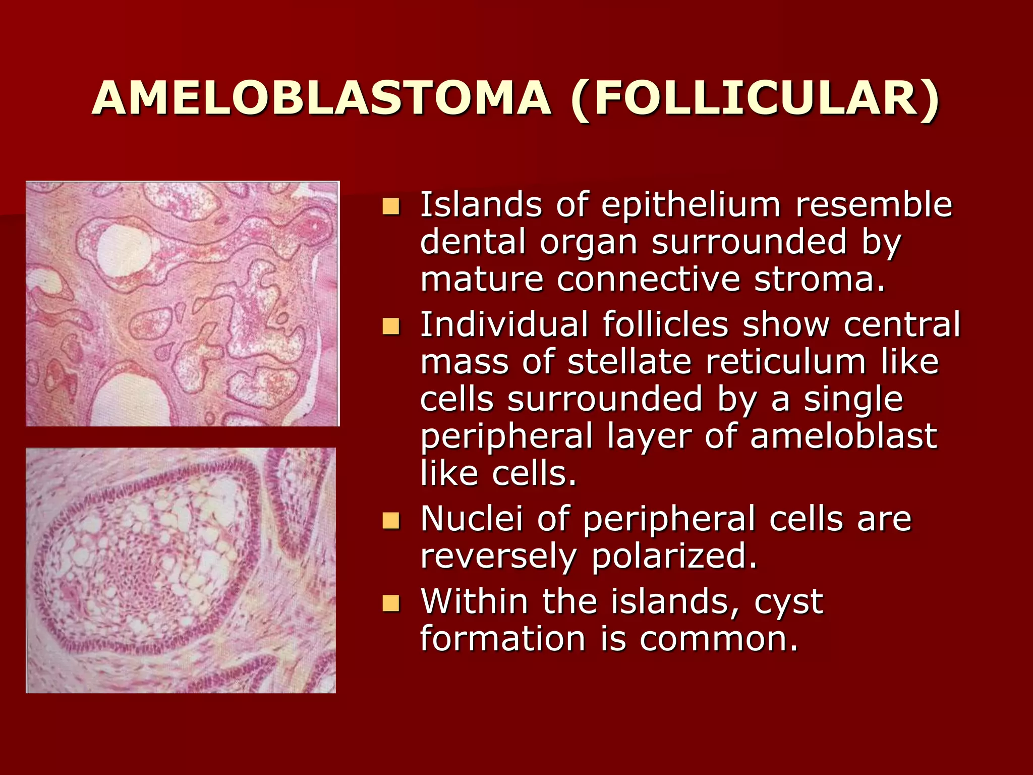 BENIGN ODONTOGENIC TUMORS IN ORAL CAVITTY | PPTX