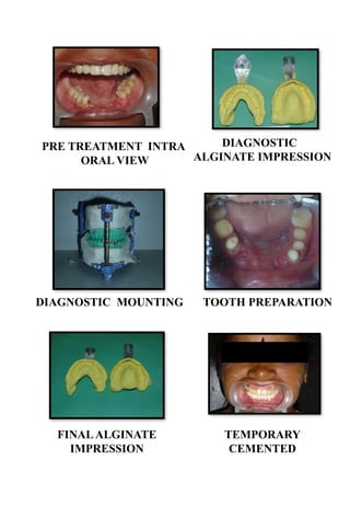 ajmal FPD CONVENTIONAL cases.pptx