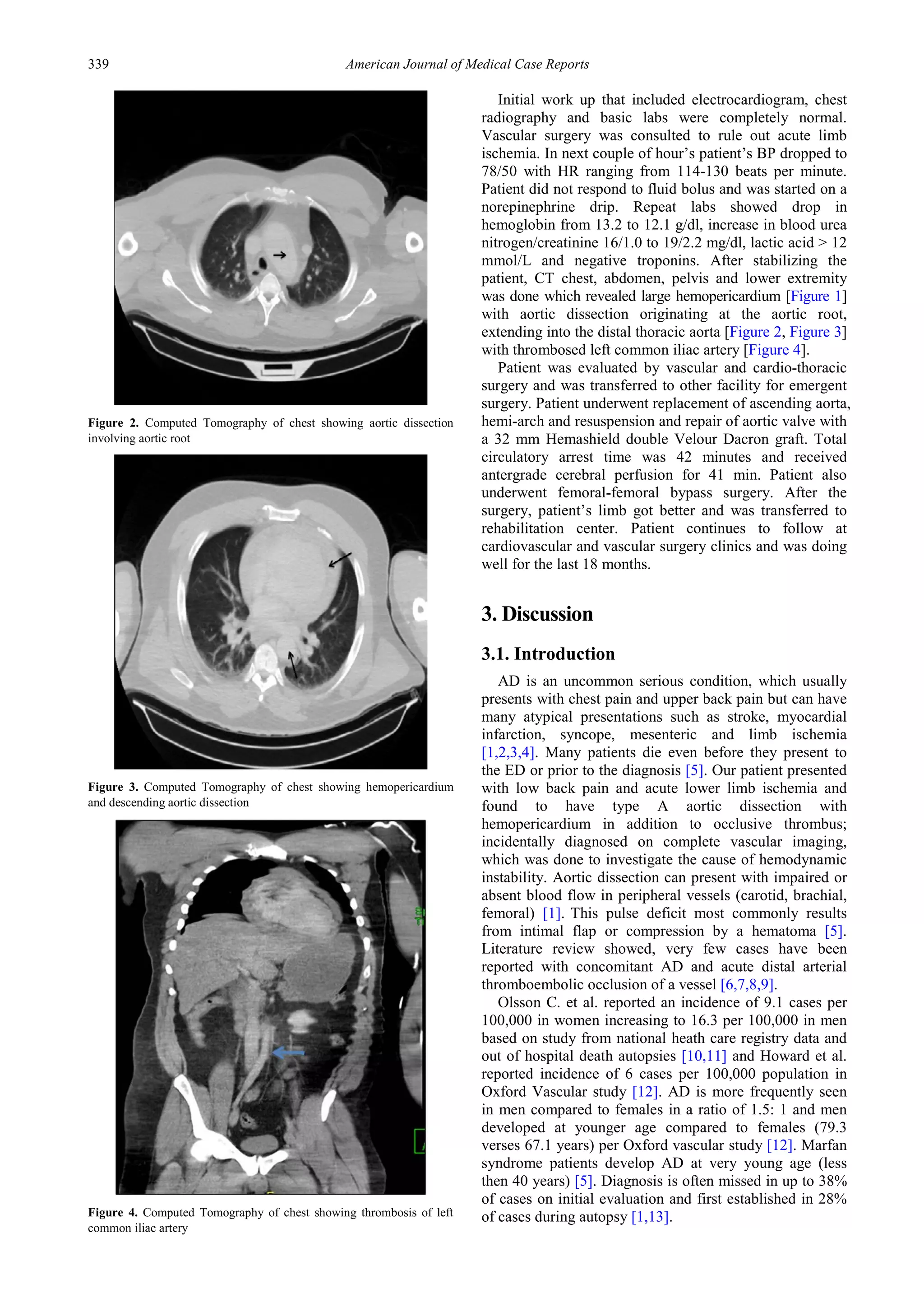 Aortic Dissection With Hemopericardium And Thrombosed Left Common Iliac