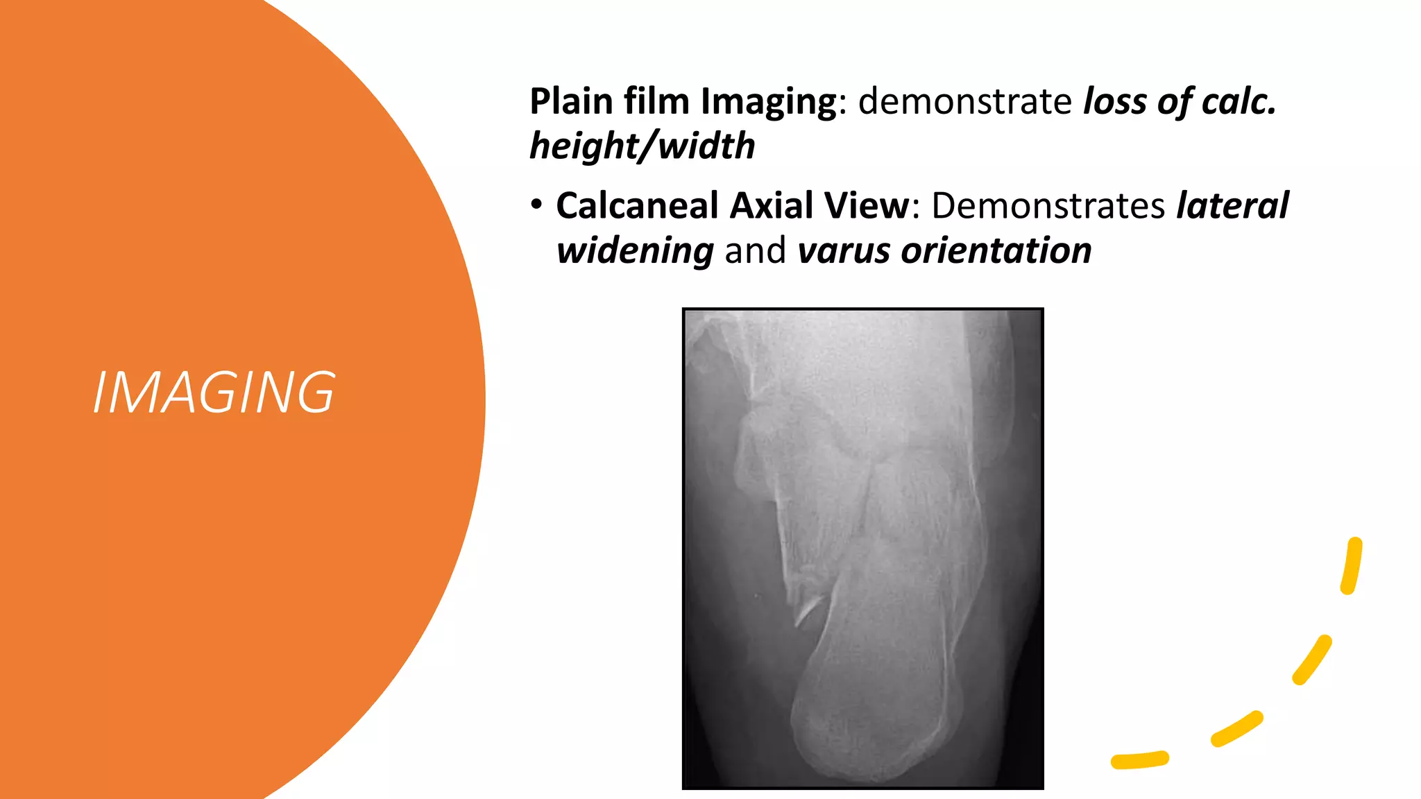 AJM Sheet: Calc Fracture | PPTX