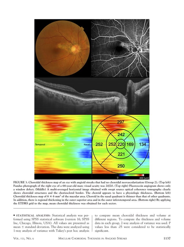 Macular Choroidal Thickness and Volume in Eyes With Angioid Streaks ...