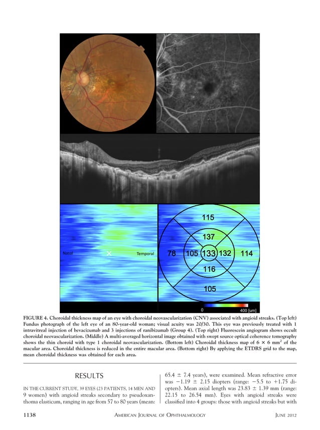 Macular Choroidal Thickness and Volume in Eyes With Angioid Streaks ...