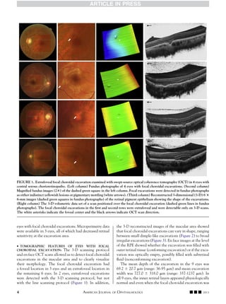 FOCAL CHOROIDAL EXCAVATION IN EYES WITH CENTRAL SEROUS ...