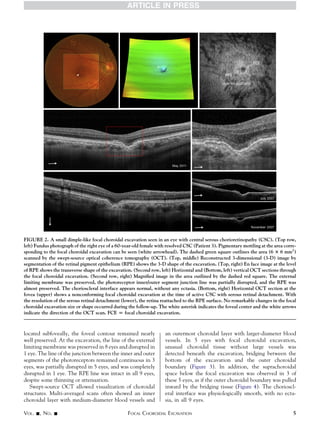 FOCAL CHOROIDAL EXCAVATION IN EYES WITH CENTRAL SEROUS ...