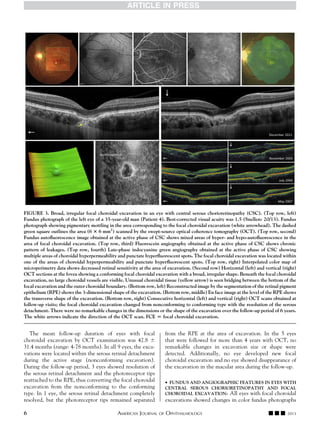 FOCAL CHOROIDAL EXCAVATION IN EYES WITH CENTRAL SEROUS ...