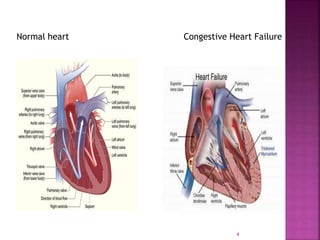 CONGESTIVE CARDIAC FAILURE | PPT
