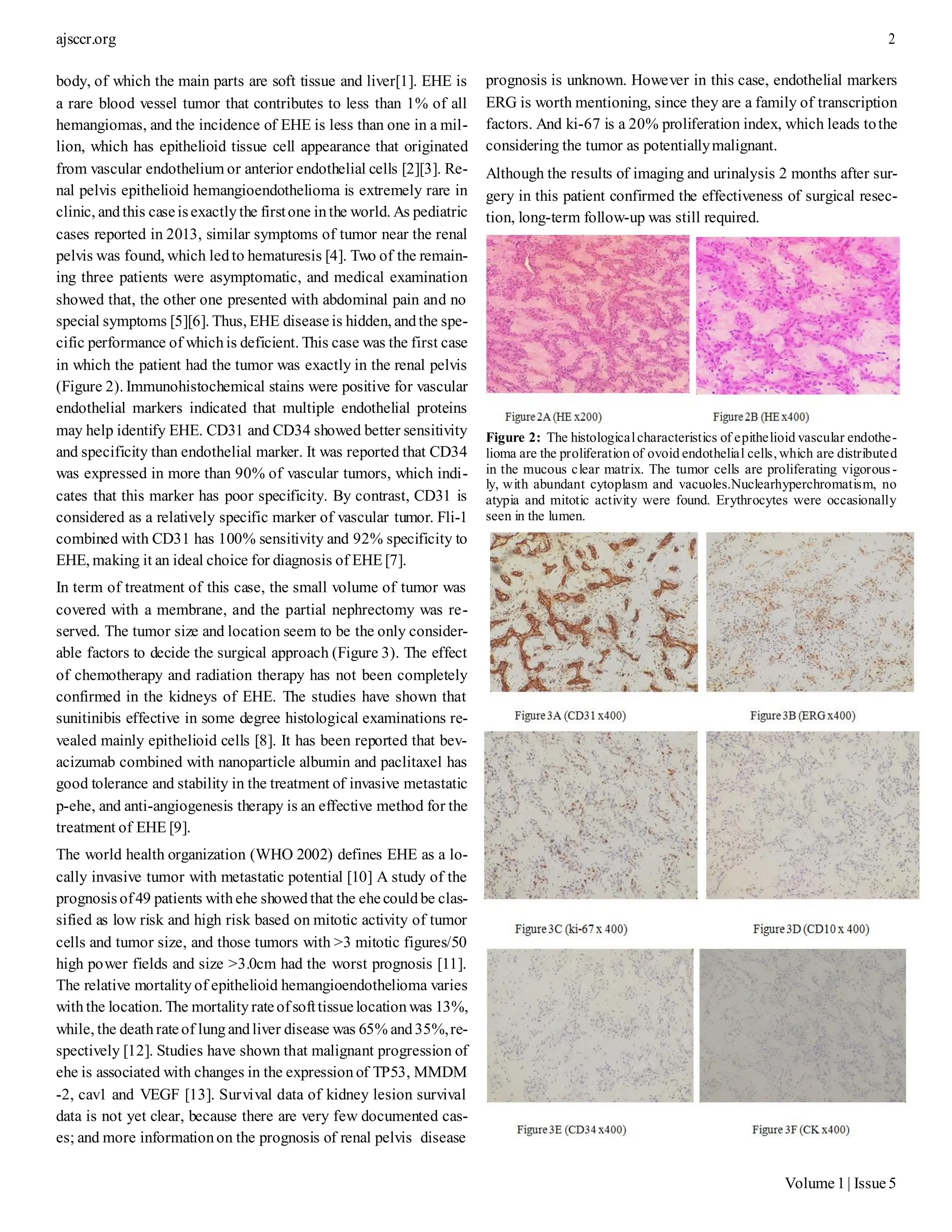 Primary Epithelioid Hemangioendothelioma of the Kidney Pelvis | PDF