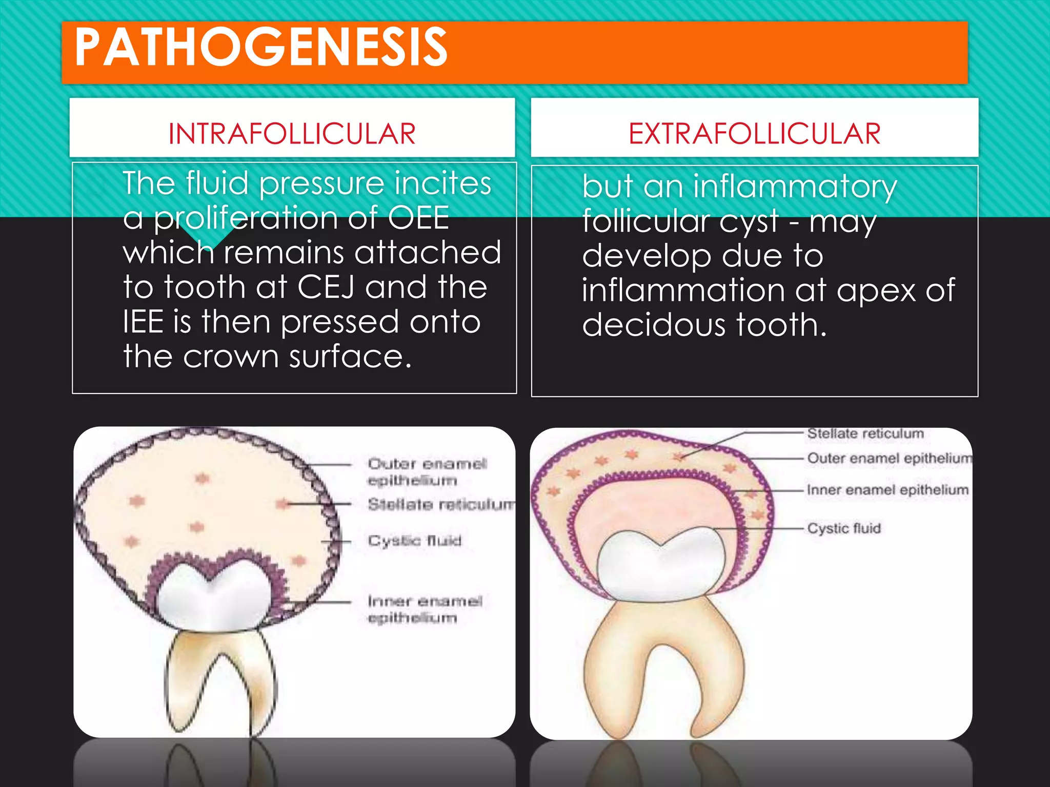 DENTIGEROUS CYST & CALCIFYING ODONTOGENIC CYST.pptx