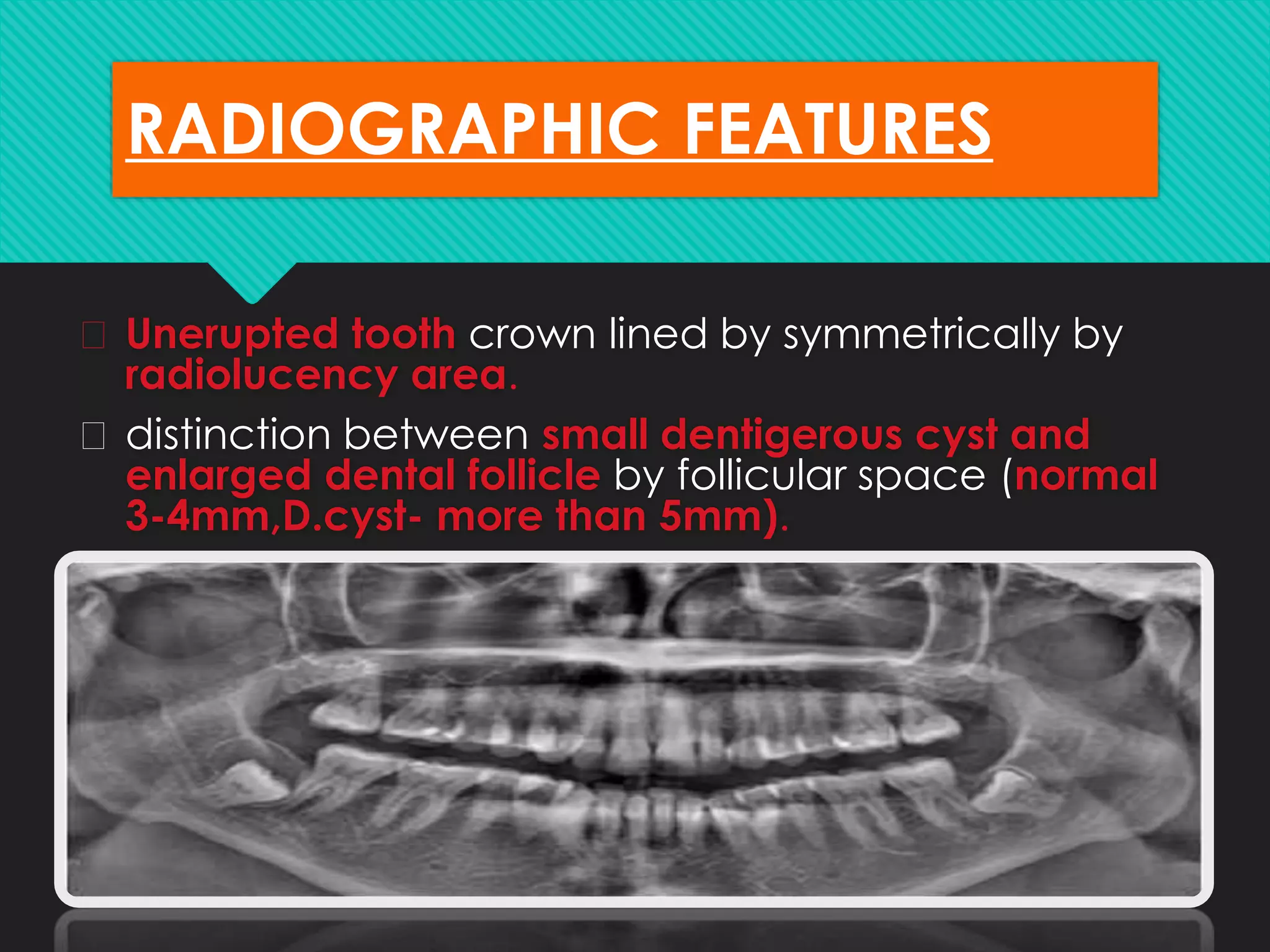 DENTIGEROUS CYST & CALCIFYING ODONTOGENIC CYST.pptx