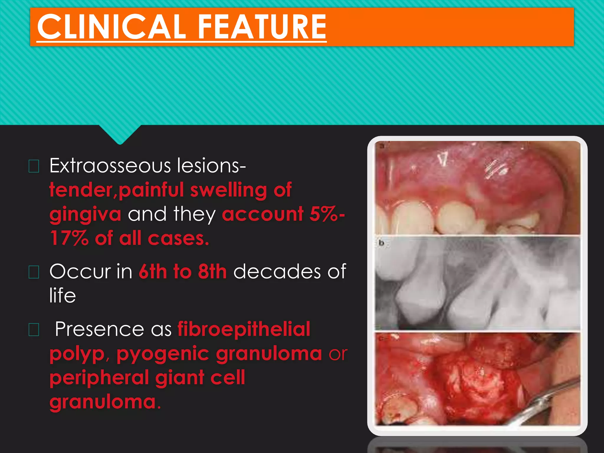 DENTIGEROUS CYST & CALCIFYING ODONTOGENIC CYST.pptx