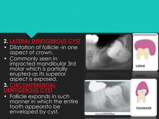 DENTIGEROUS CYST & CALCIFYING ODONTOGENIC CYST.pptx | Dental Health ...