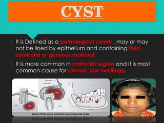 DENTIGEROUS CYST & CALCIFYING ODONTOGENIC CYST.pptx