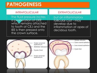 Pathogenesis Of Dentigerous Cyst