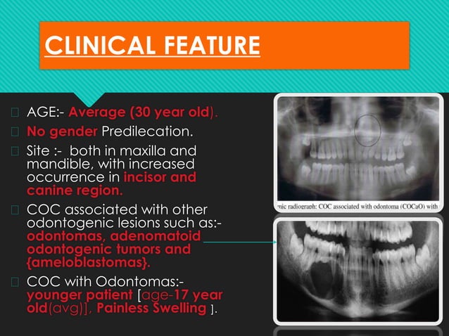 Dentigerous Cyst And Calcifying Odontogenic Cystpptx