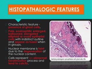 Ghost Cells Calcifying Odontogenic Cyst
