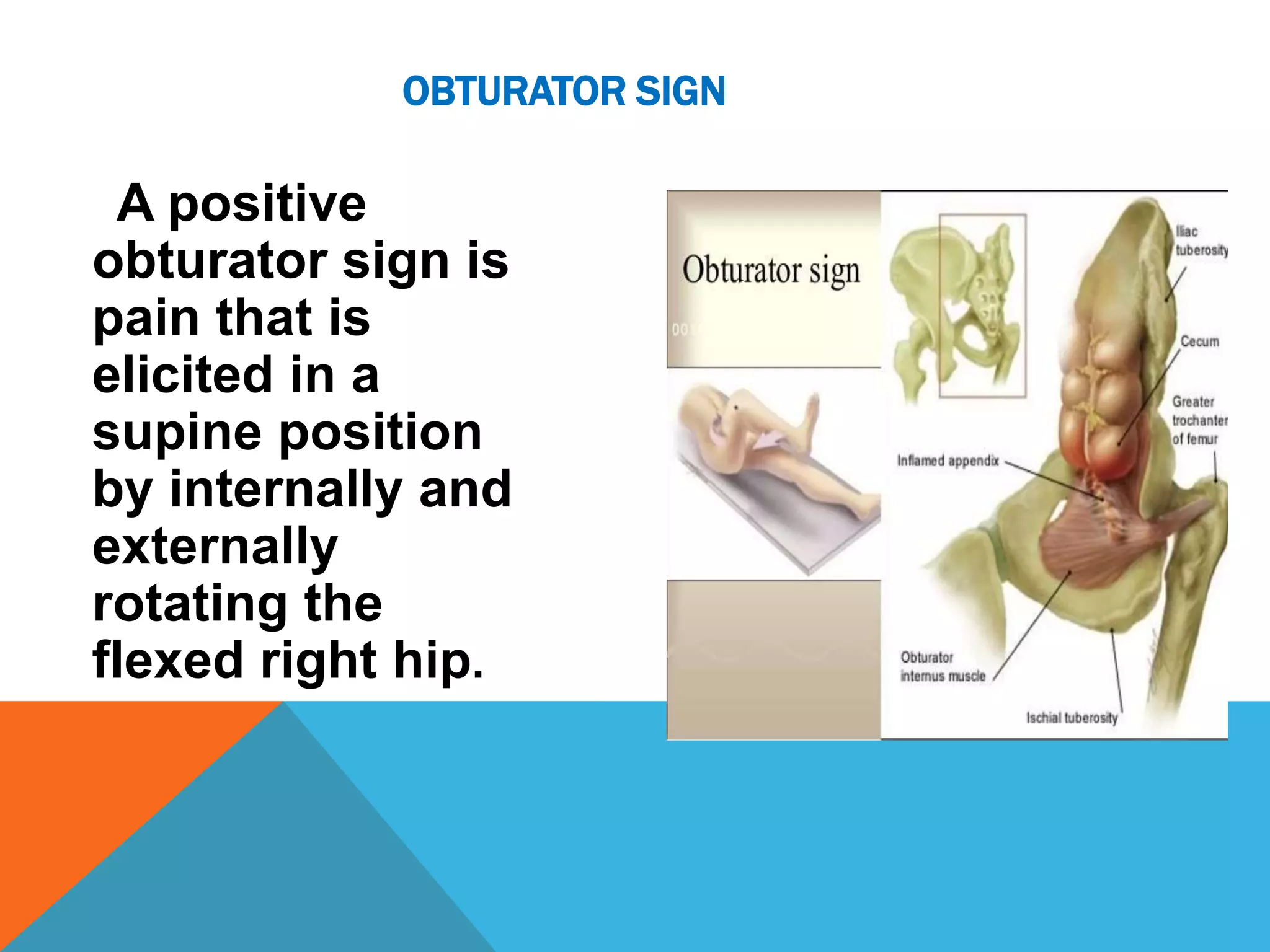 Appendicitis overview | PPTX