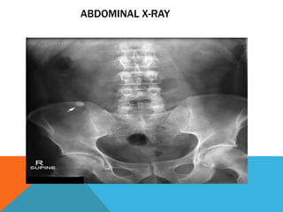 Appendicitis overview | PPTX