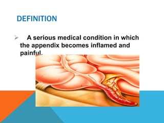 Appendicitis overview | PPTX