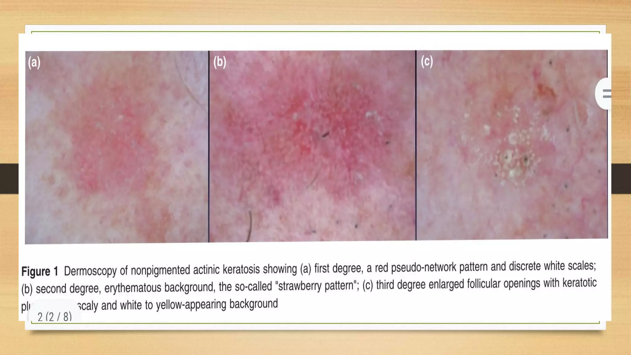 Actinic Keratosis .pdf