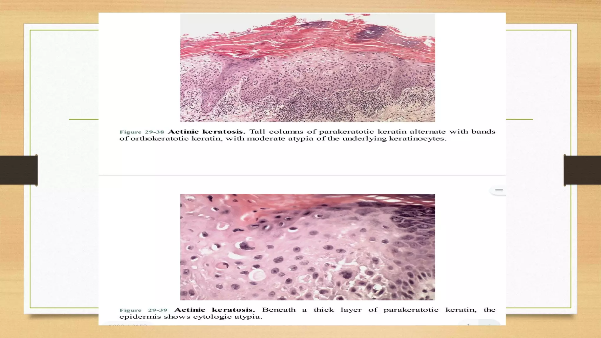 Actinic Keratosis .pdf