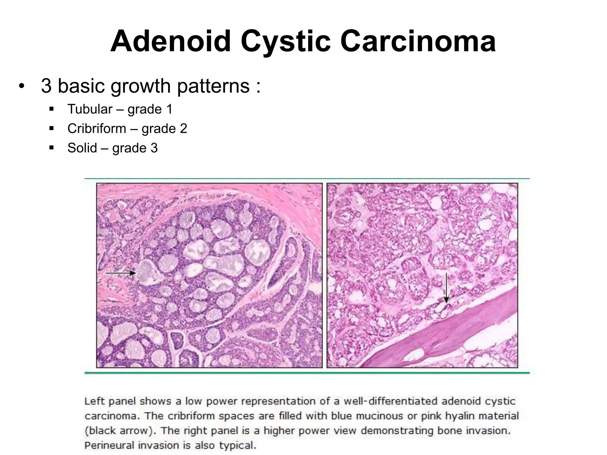 Salivary gland tumours | PPTX