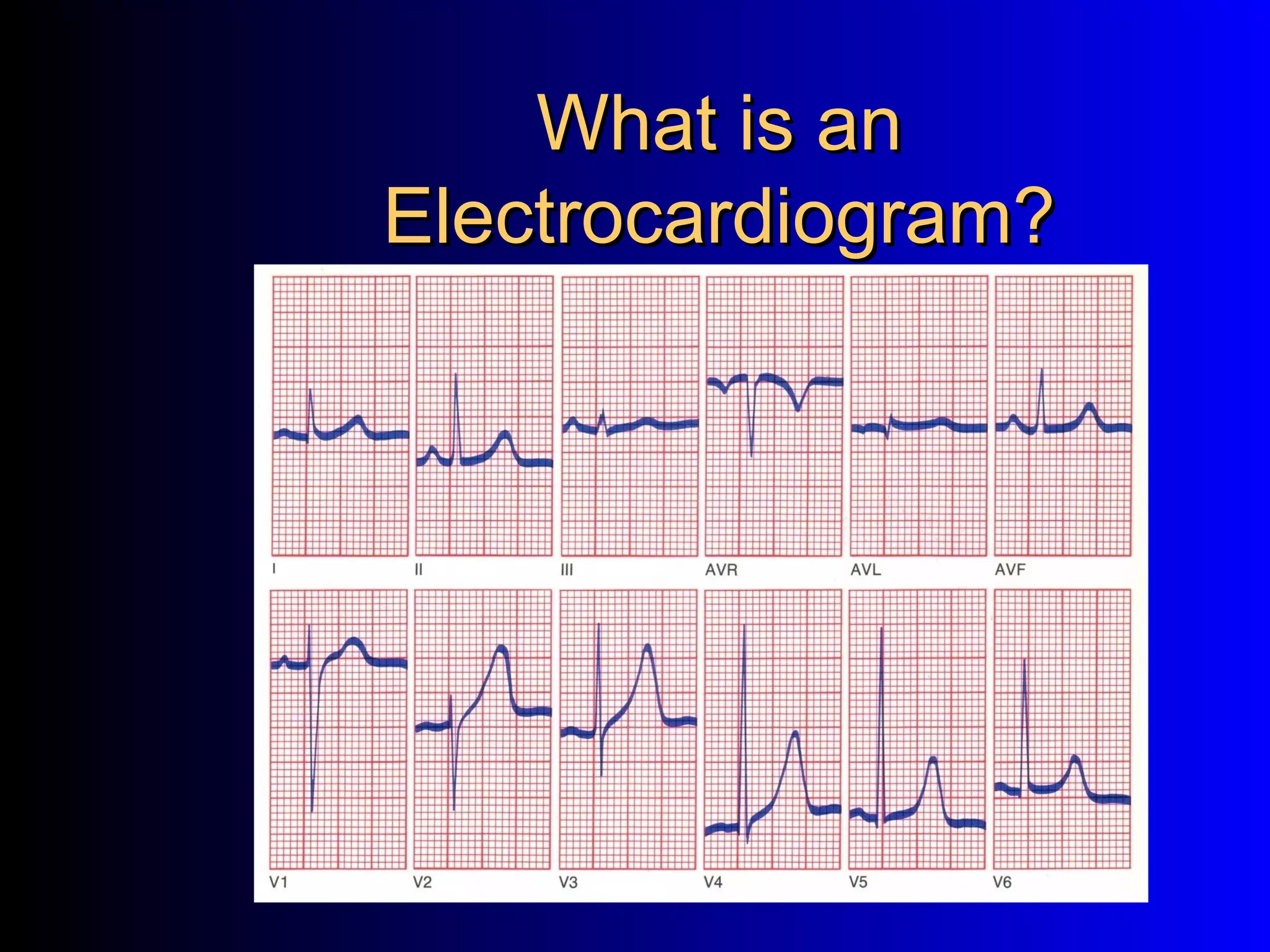 Demystifying clinical electrocardiography august, 2013 | PPT