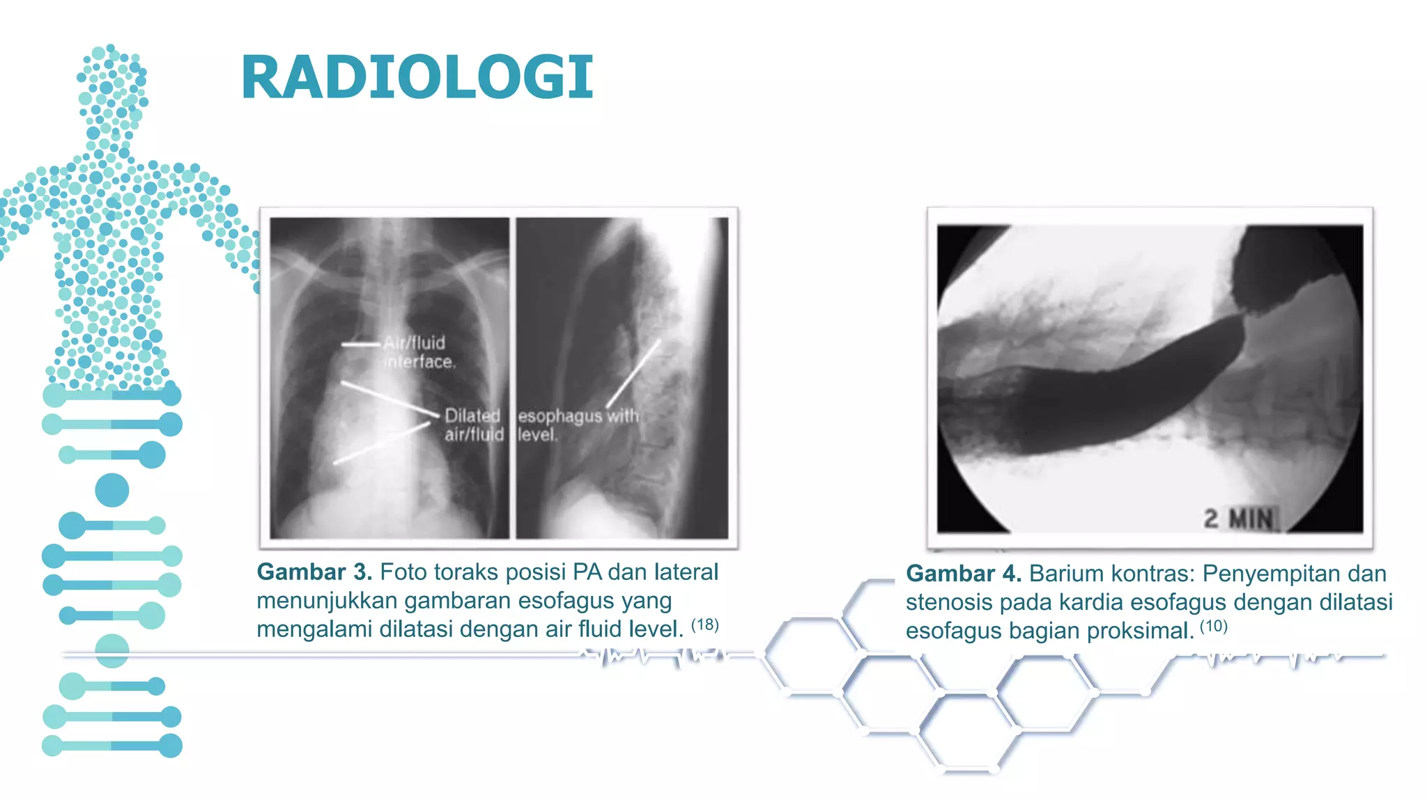 Akalasia esofagus | PPTX