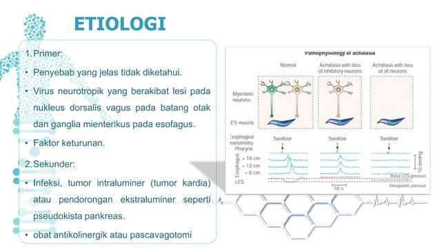 Akalasia esofagus | PPTX