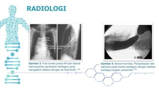 Akalasia esofagus | PPTX